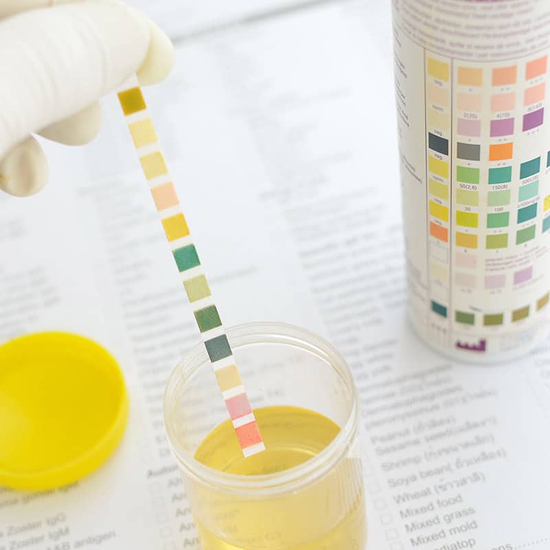 Urinalysis With Reflex